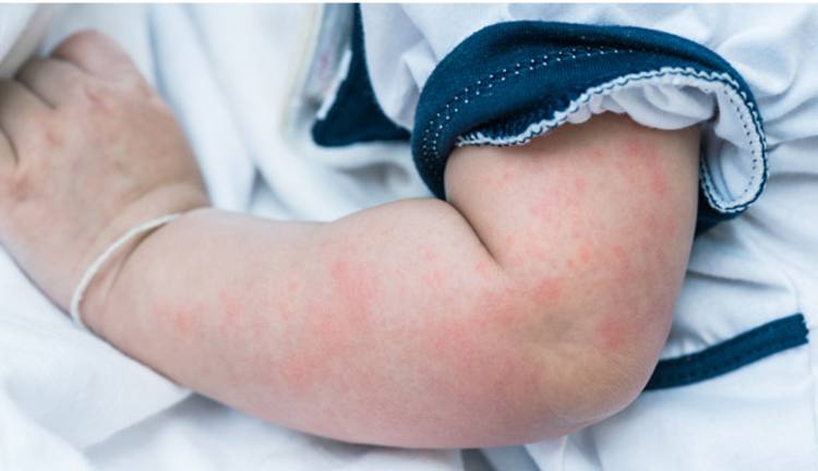 Urticaria in Children: Symptoms, Causes and Treatment