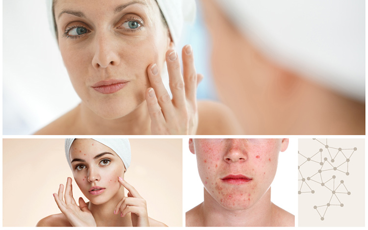 What is Hormonal Acne? Causes, Symptoms and Treatment Options